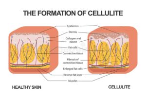How to Get rid of Cellulite – Blog Home